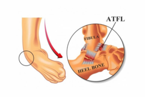ATFL Injury Care Bangalore | Ligament Injury Treatment