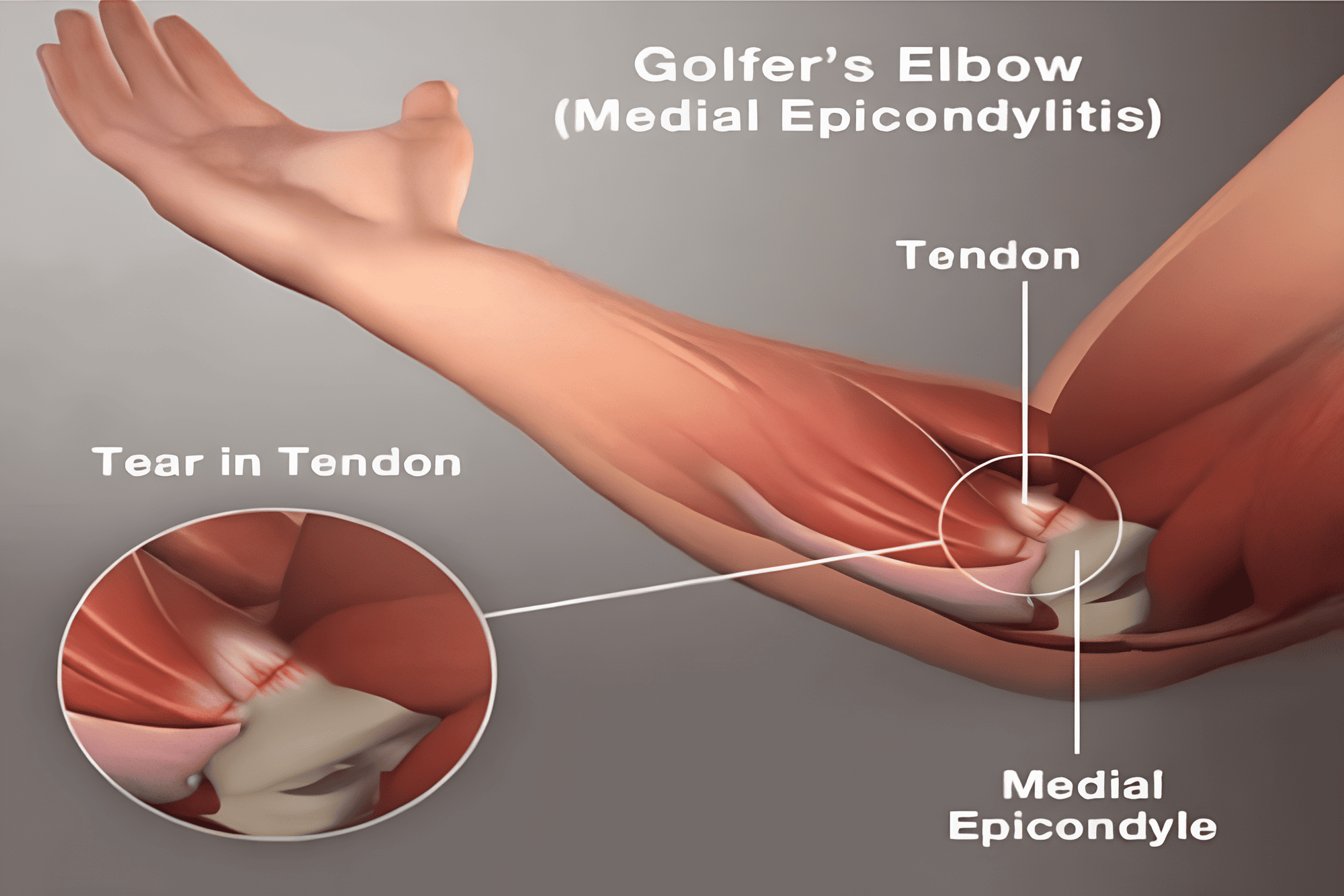 Golfer’s Elbow Treatment Bangalore | Elbow Specialist